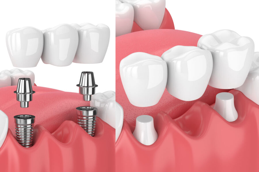 How Do Dental Bridges Work? | Rockingham Prosthodontics